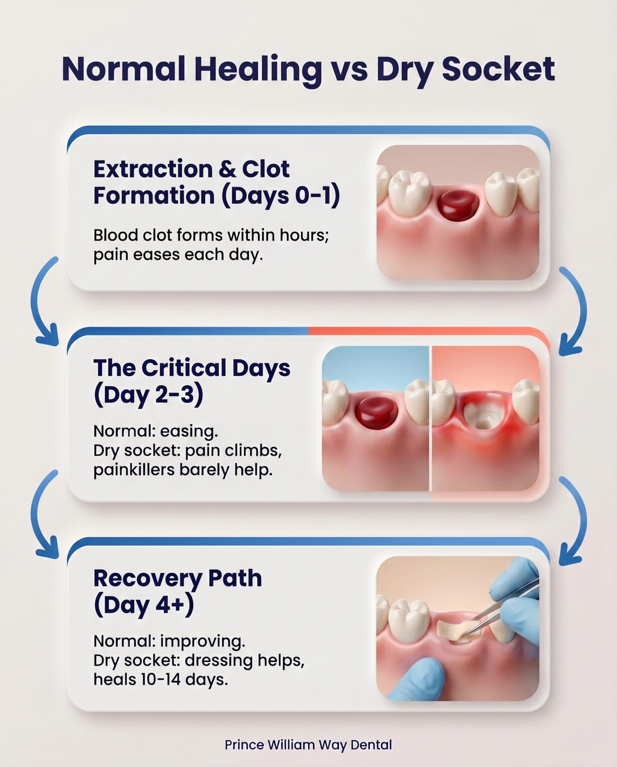 Dry Socket: Sharp Pain Days After an Extraction | Prince William Way Dental