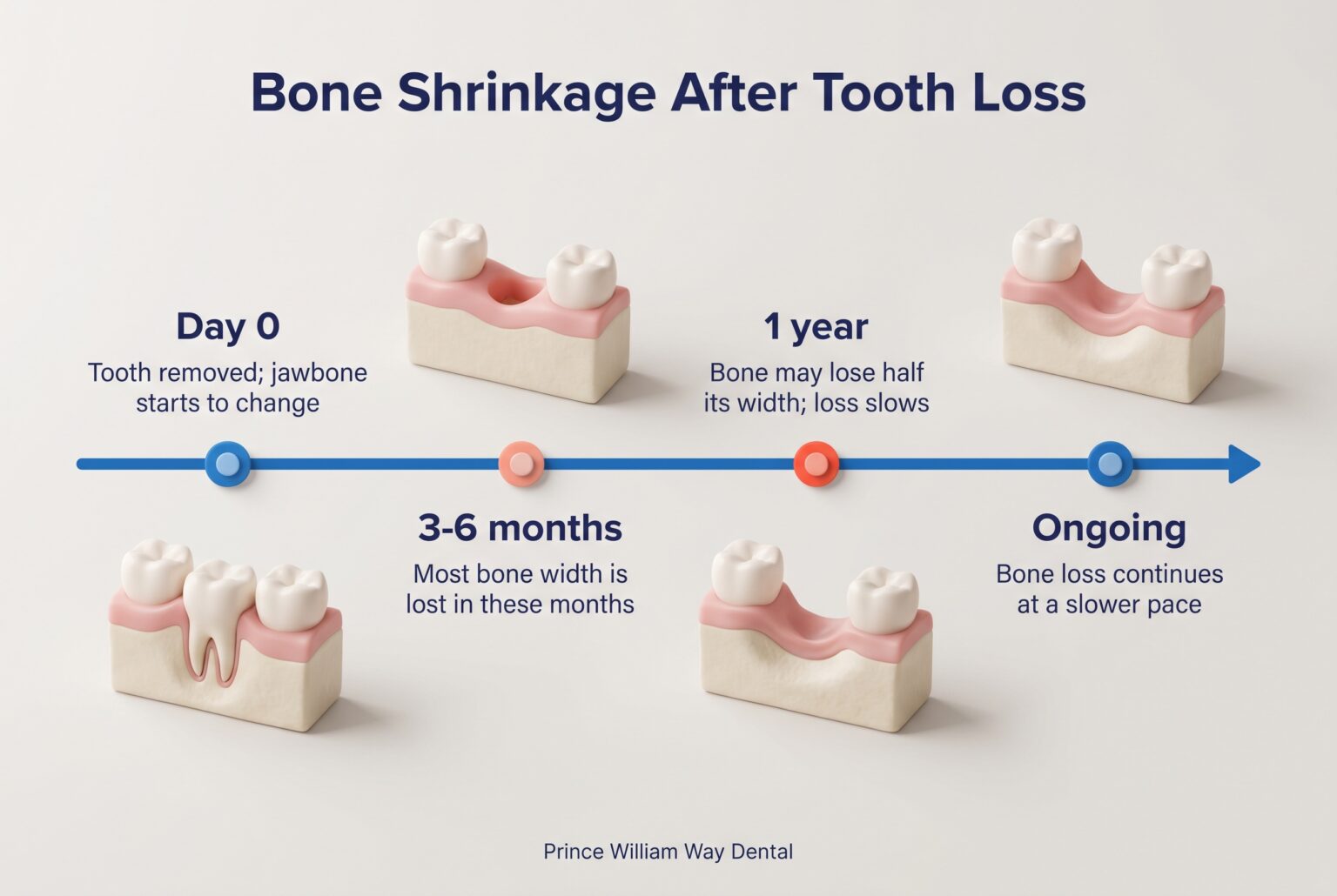 Replacing a Missing Tooth: Implant, Bridge or Denture? | Prince William ...