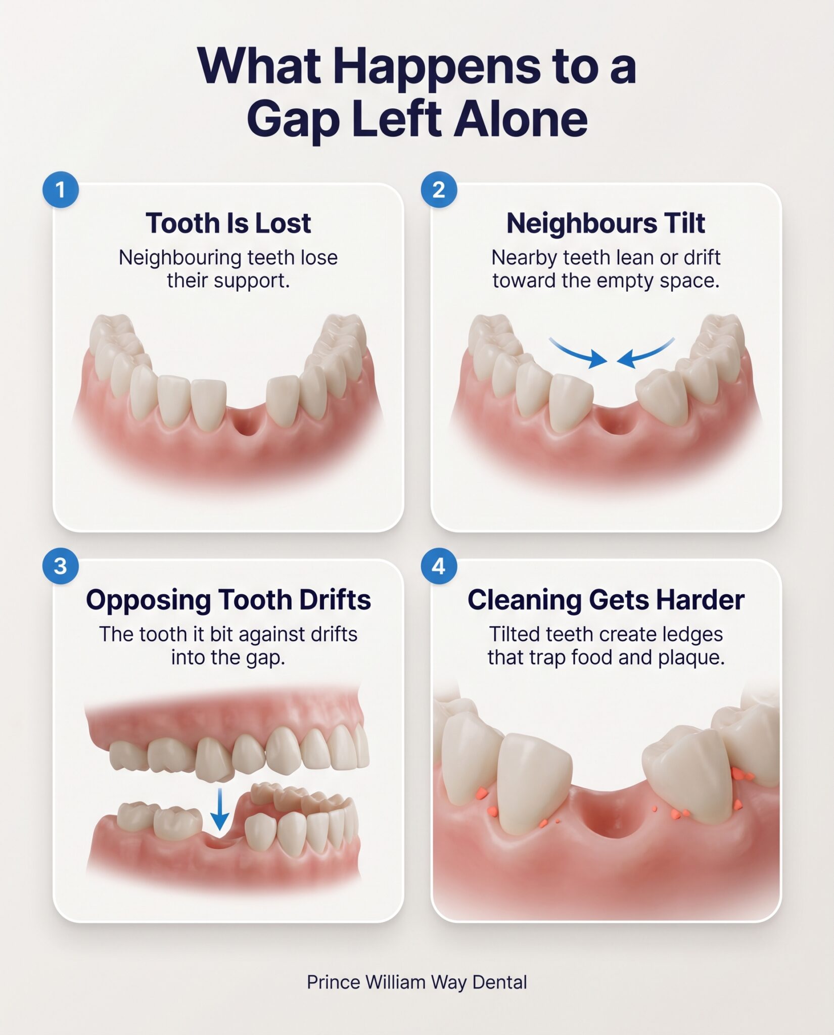 Replacing a Missing Tooth: Implant, Bridge or Denture? | Prince William ...